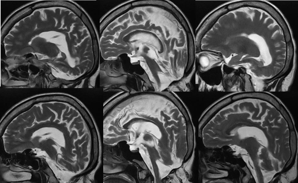 Chiari 3 Malformation
